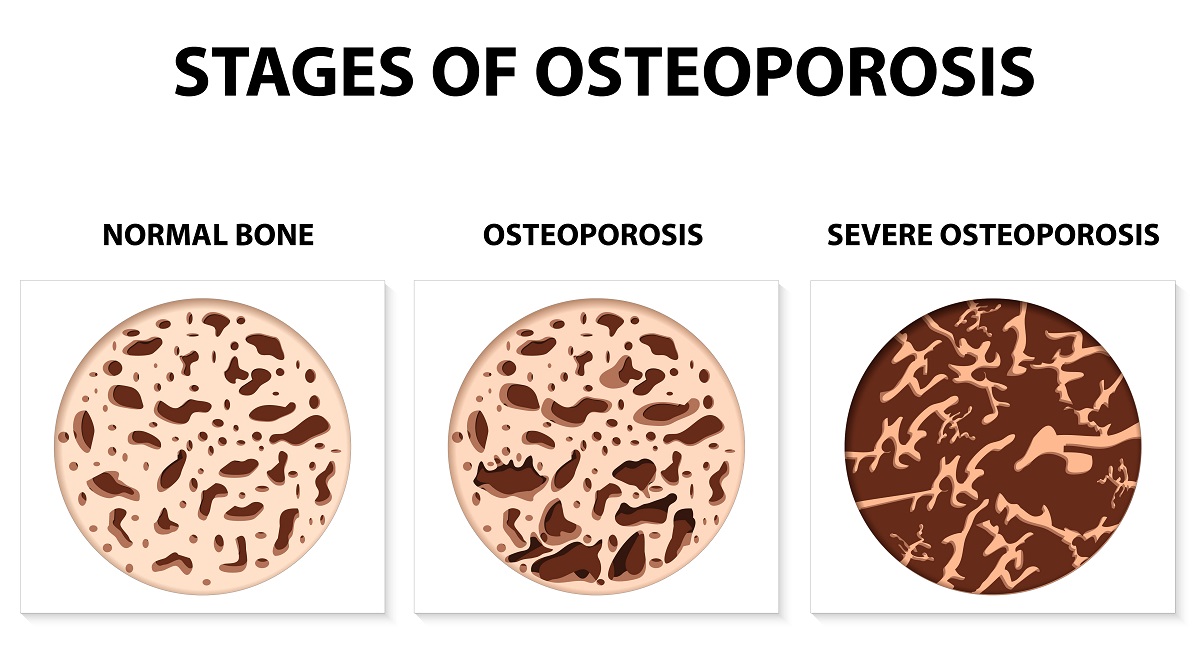 Tips For Keeping Senior Bones And Joints Strong